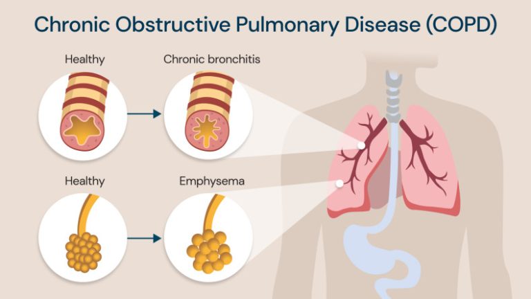 COPD – Specialisaties – Holystaete – Vlaardingen